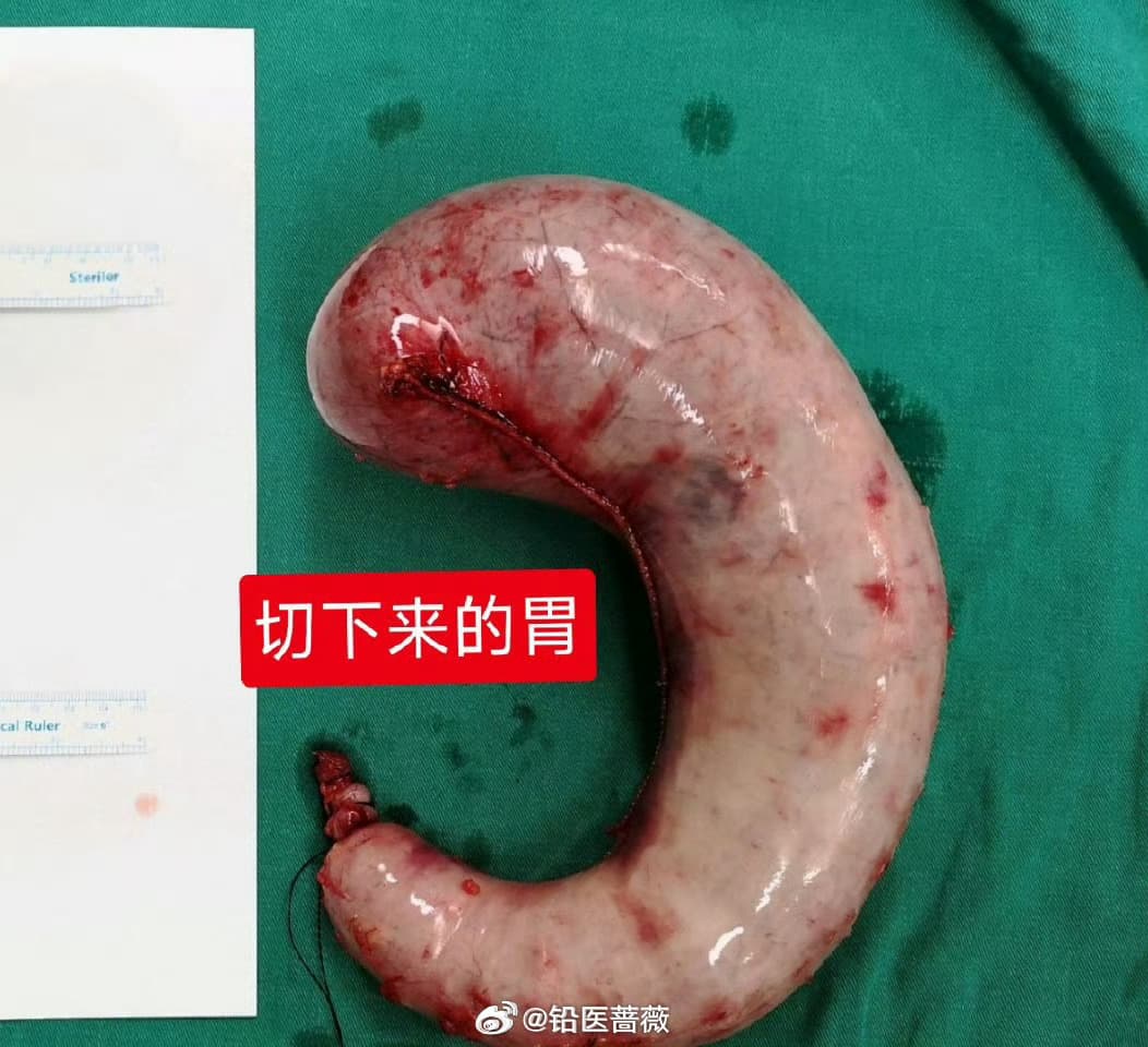 10 Pounds of Food Removed from Woman's Stomach After Binge Eating ...